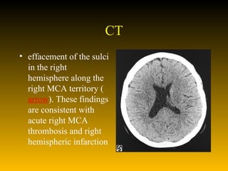 Acute infarction cerebral | PPT