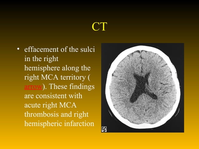 Acute infarction cerebral | PPT | Brain and Nervous System Disorders ...