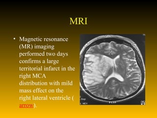 Acute infarction cerebral | PPT