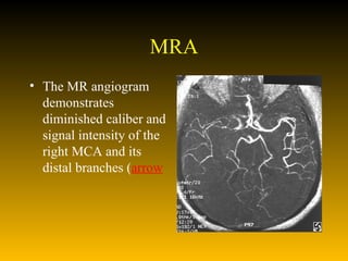 Acute infarction cerebral | PPT