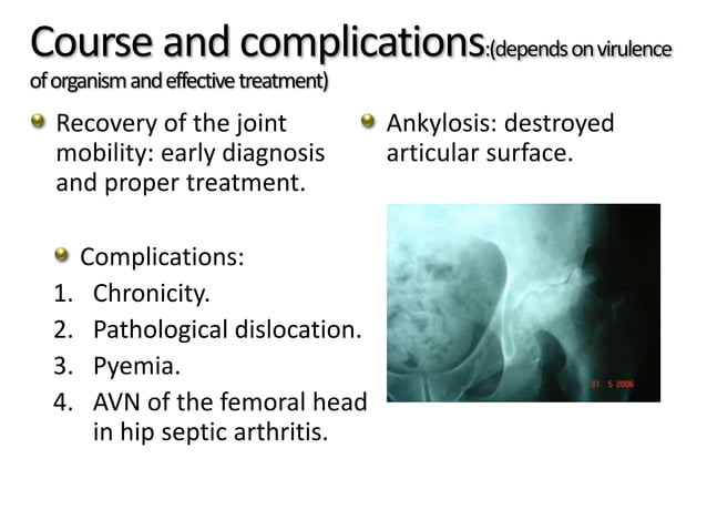 Acute infections of bones and joints | PPTX | Bone and Joint Conditions | Diseases and Conditions