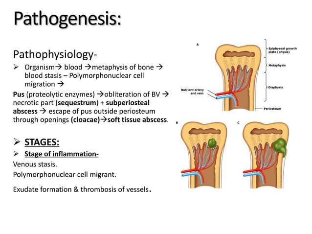 Acute infections of bones and joints | PPTX | Bone and Joint Conditions ...