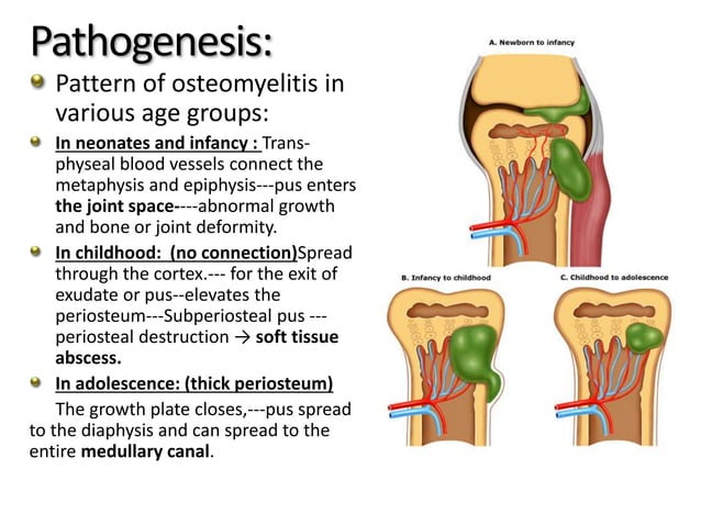 Acute infections of bones and joints | PPTX | Bone and Joint Conditions ...