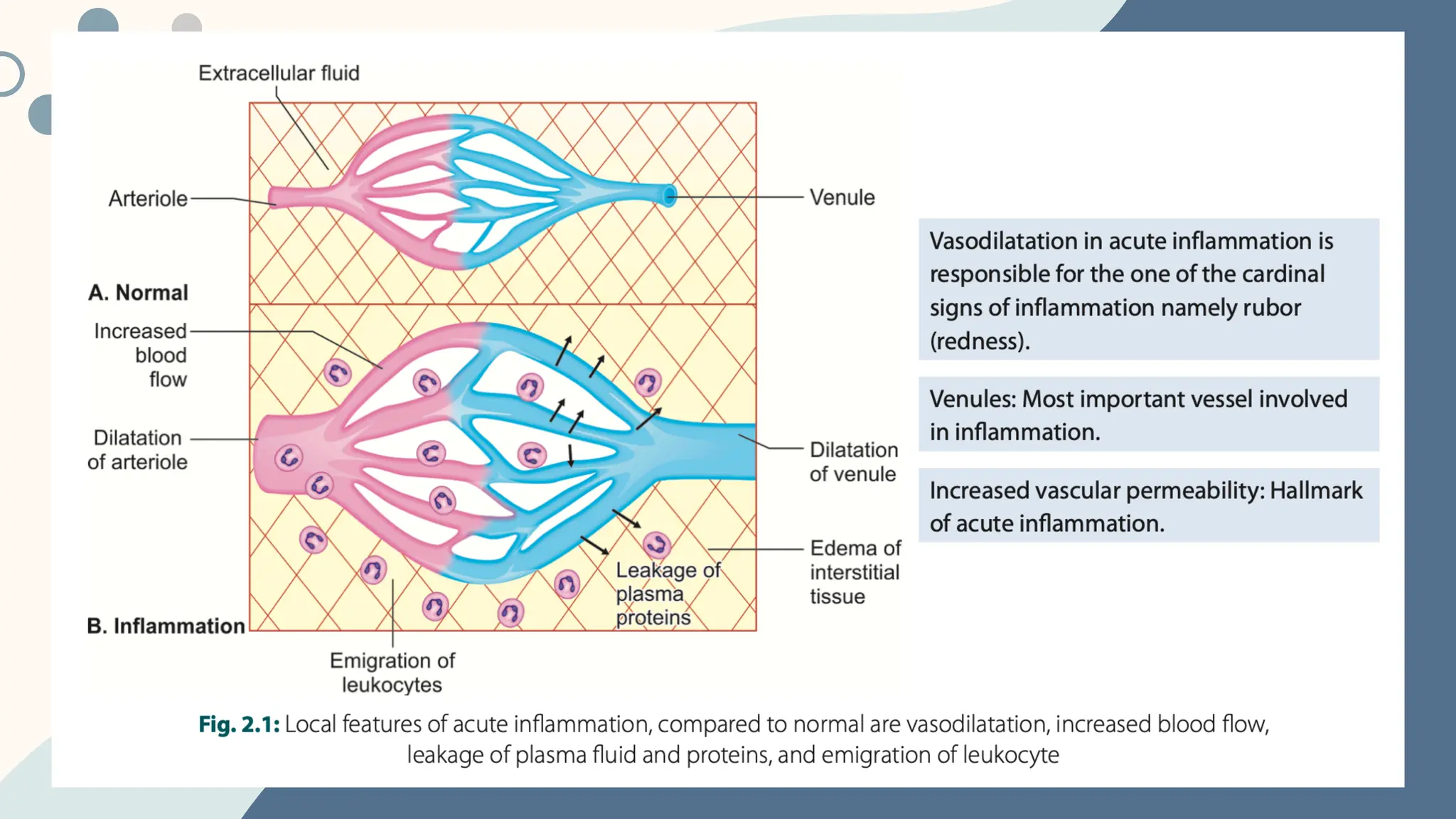 ACUTE INFLAMMATION - CAUSES, MECHANISMS, CARDINAL SIGNS, VASCULAR AND ...