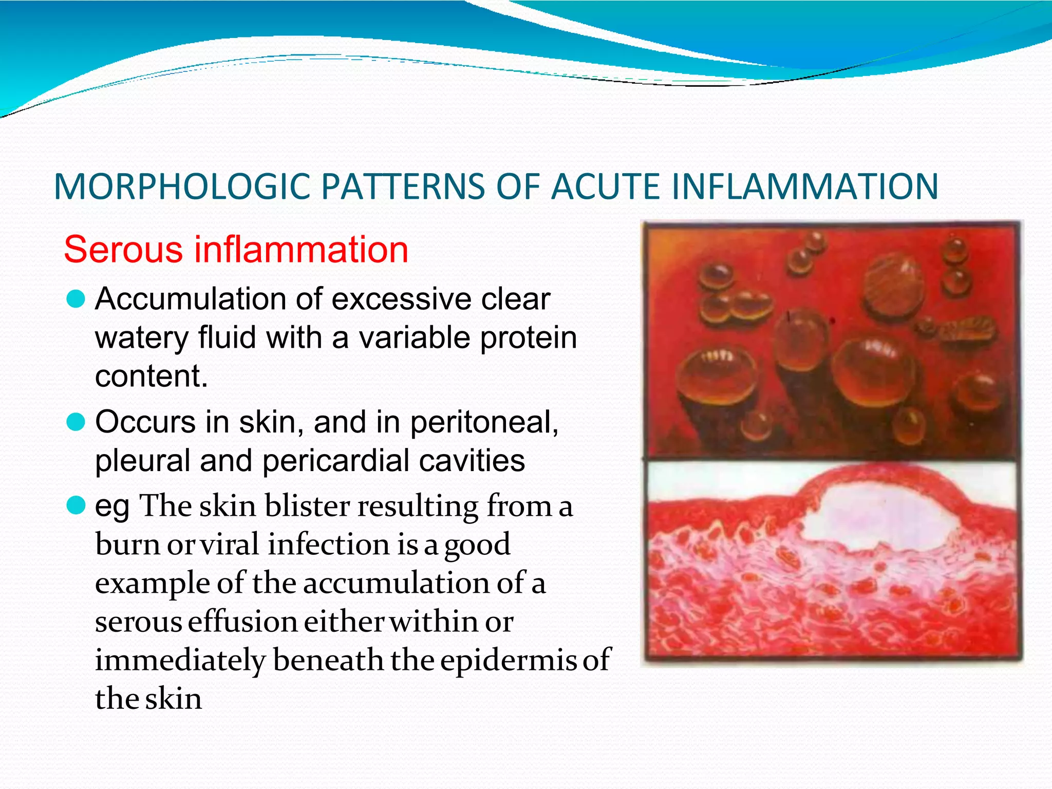 acuteinflammation-161003171647.pptx | Free Download