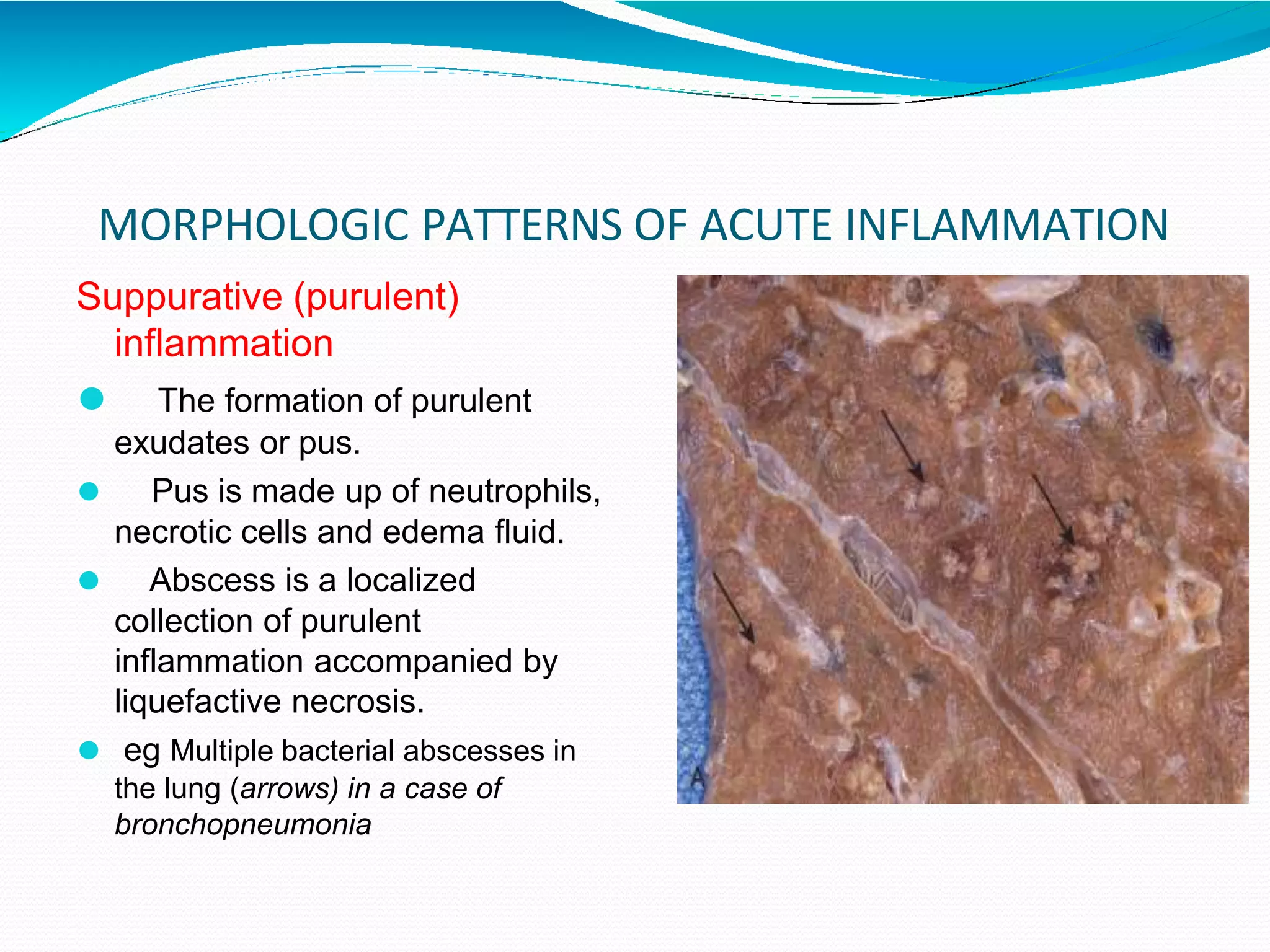 acuteinflammation-161003171647.pptx | Free Download