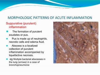 acuteinflammation-161003171647.pptx