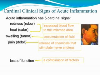acuteinflammation-161003171647.pptx | Free Download