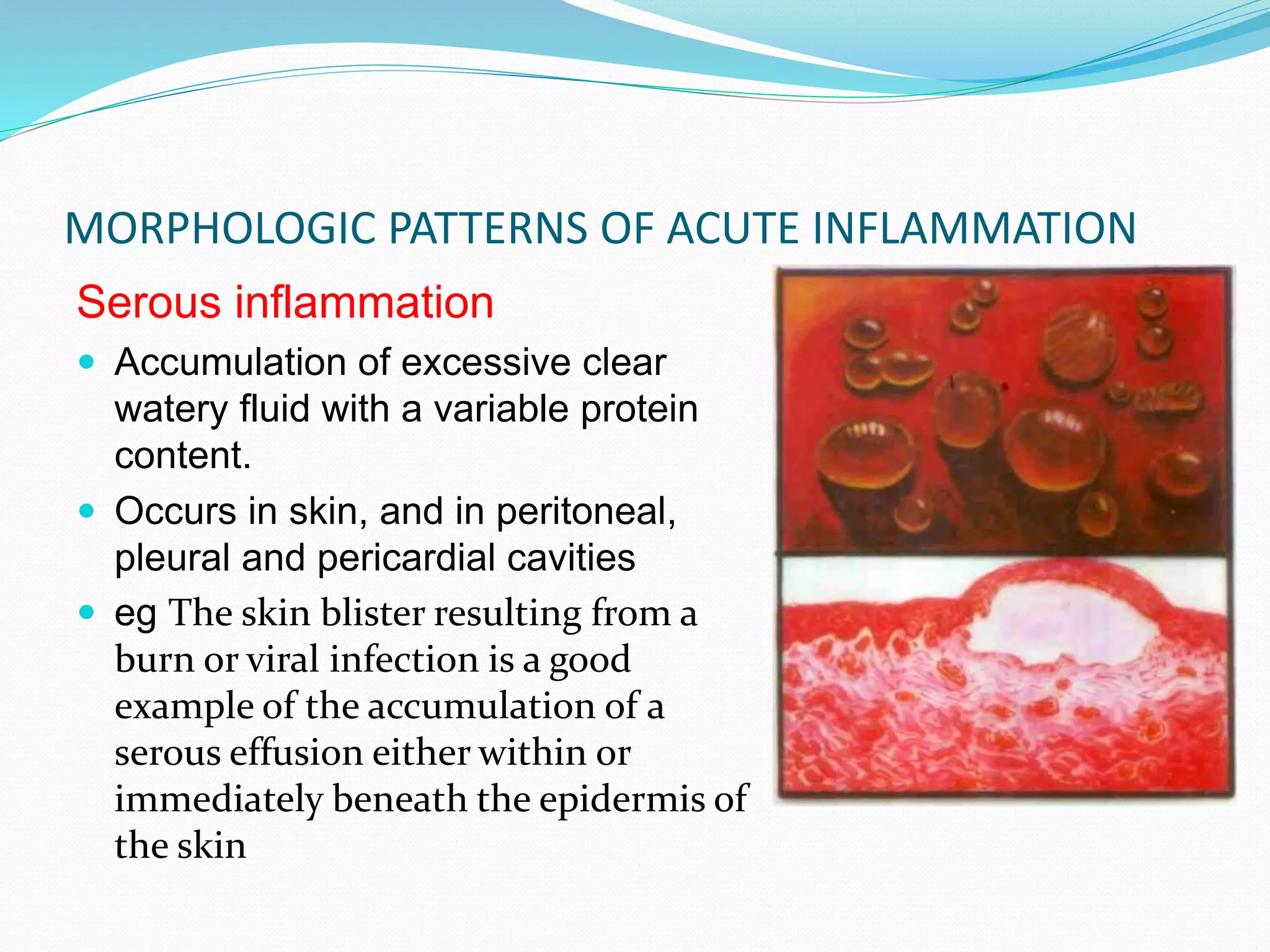 Acute inflammation | PPTX | Blood Disorders | Diseases and Conditions