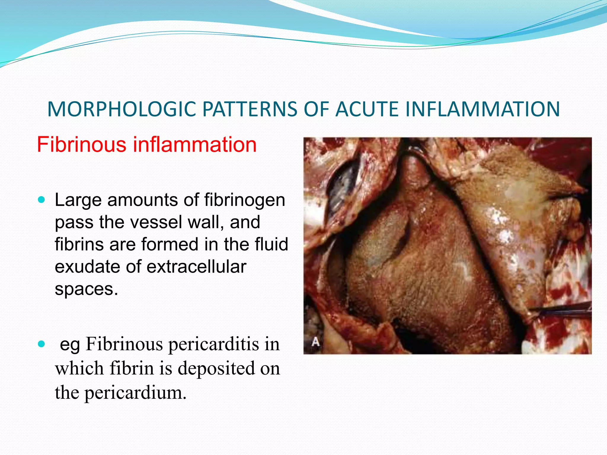 Acute inflammation | PPTX