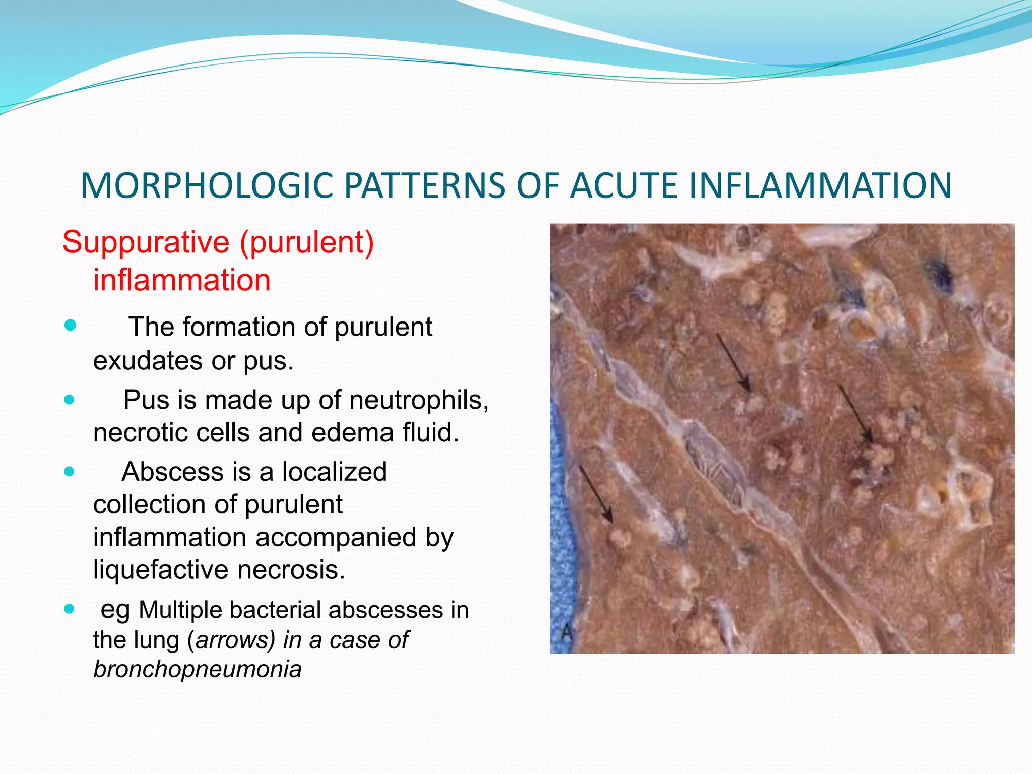 Acute inflammation | PPTX | Blood Disorders | Diseases and Conditions