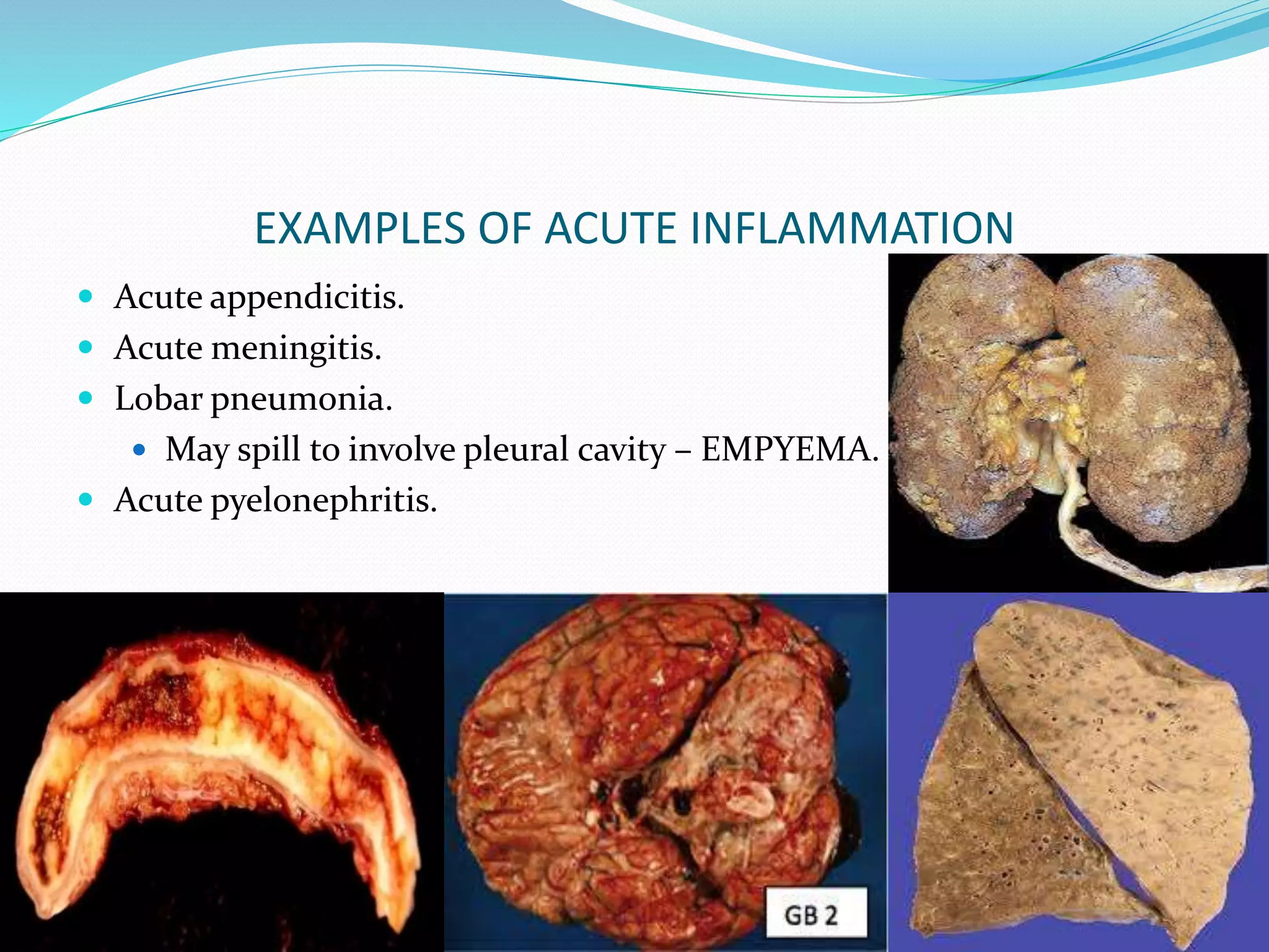 Acute inflammation | PPTX | Blood Disorders | Diseases and Conditions