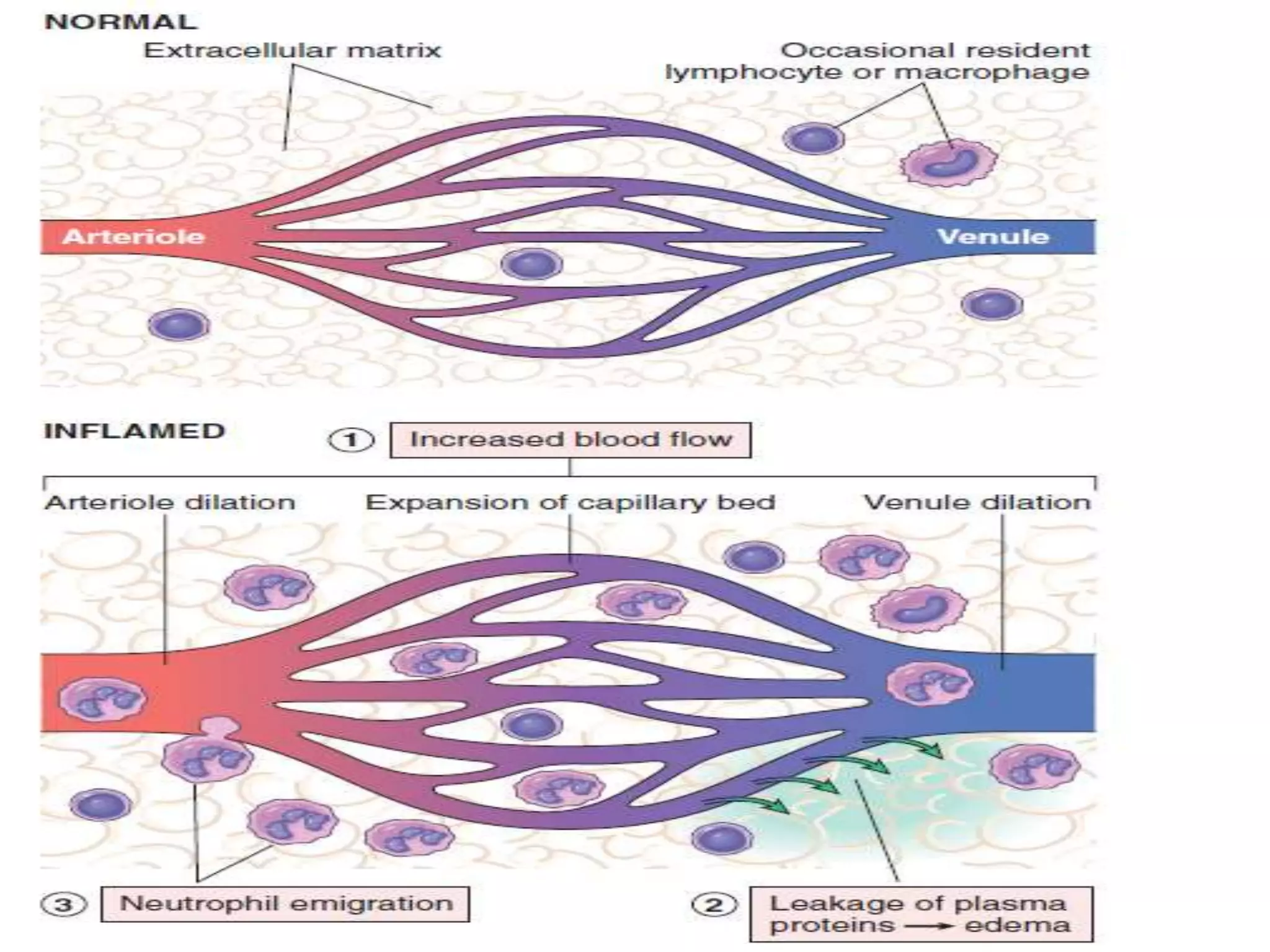 Acute inflammation | PPTX
