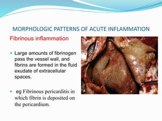 Acute inflammation | PPTX