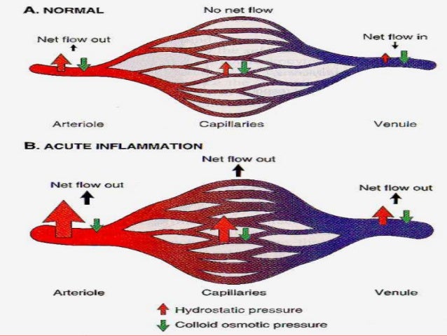 Acute inflammation