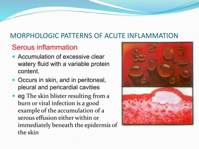 Acute inflammation in pathologic basis of diseases | PPT