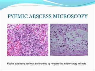 Acute inflammation | PPT