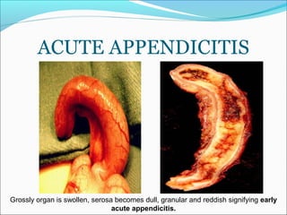 Acute inflammation | PPT