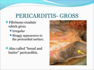 Acute inflammation | PPT