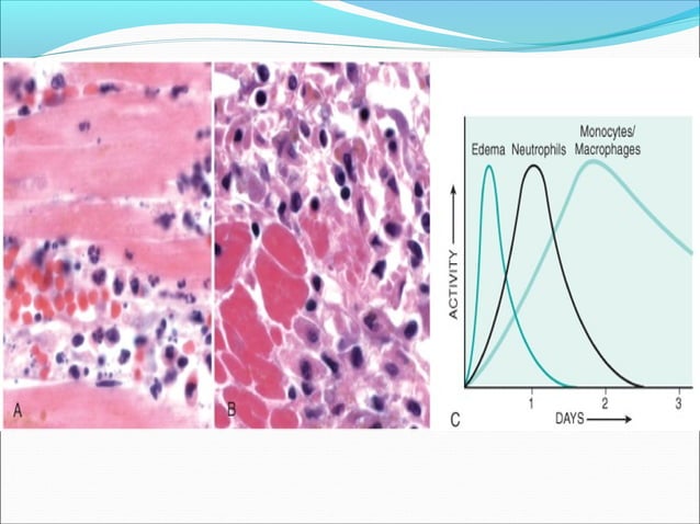 Acute inflammation(pathology) | PPT