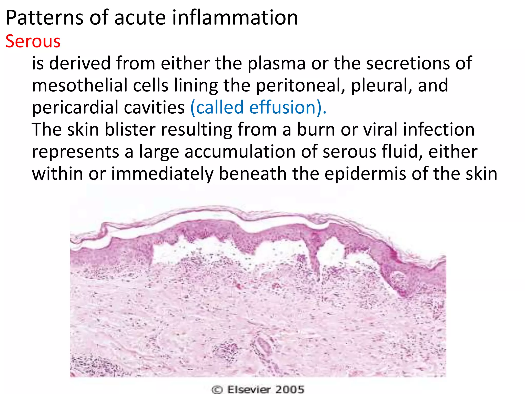 Acute inflammation | PPTX | Blood Disorders | Diseases and Conditions
