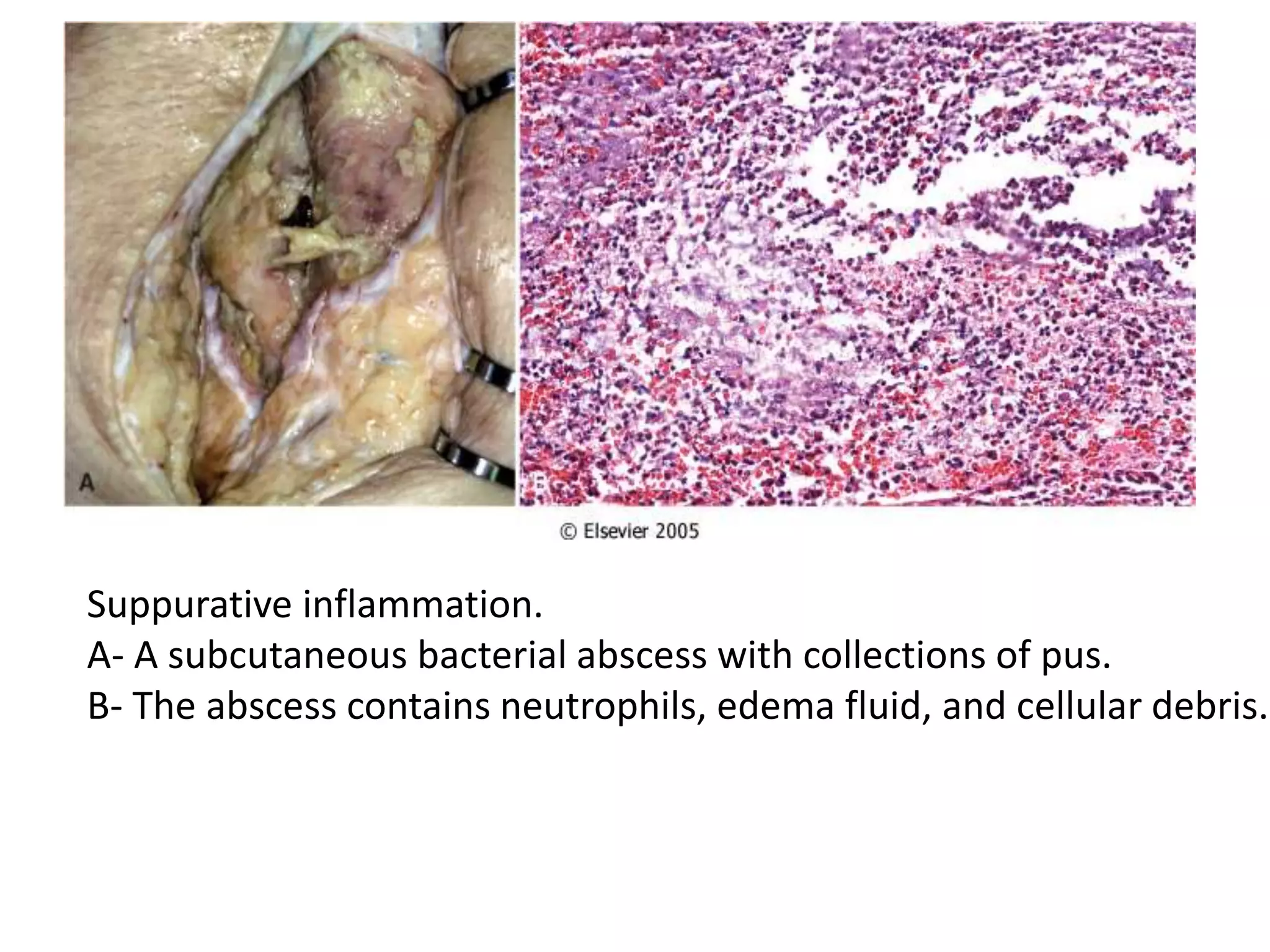 Acute inflammation | PPTX | Blood Disorders | Diseases and Conditions