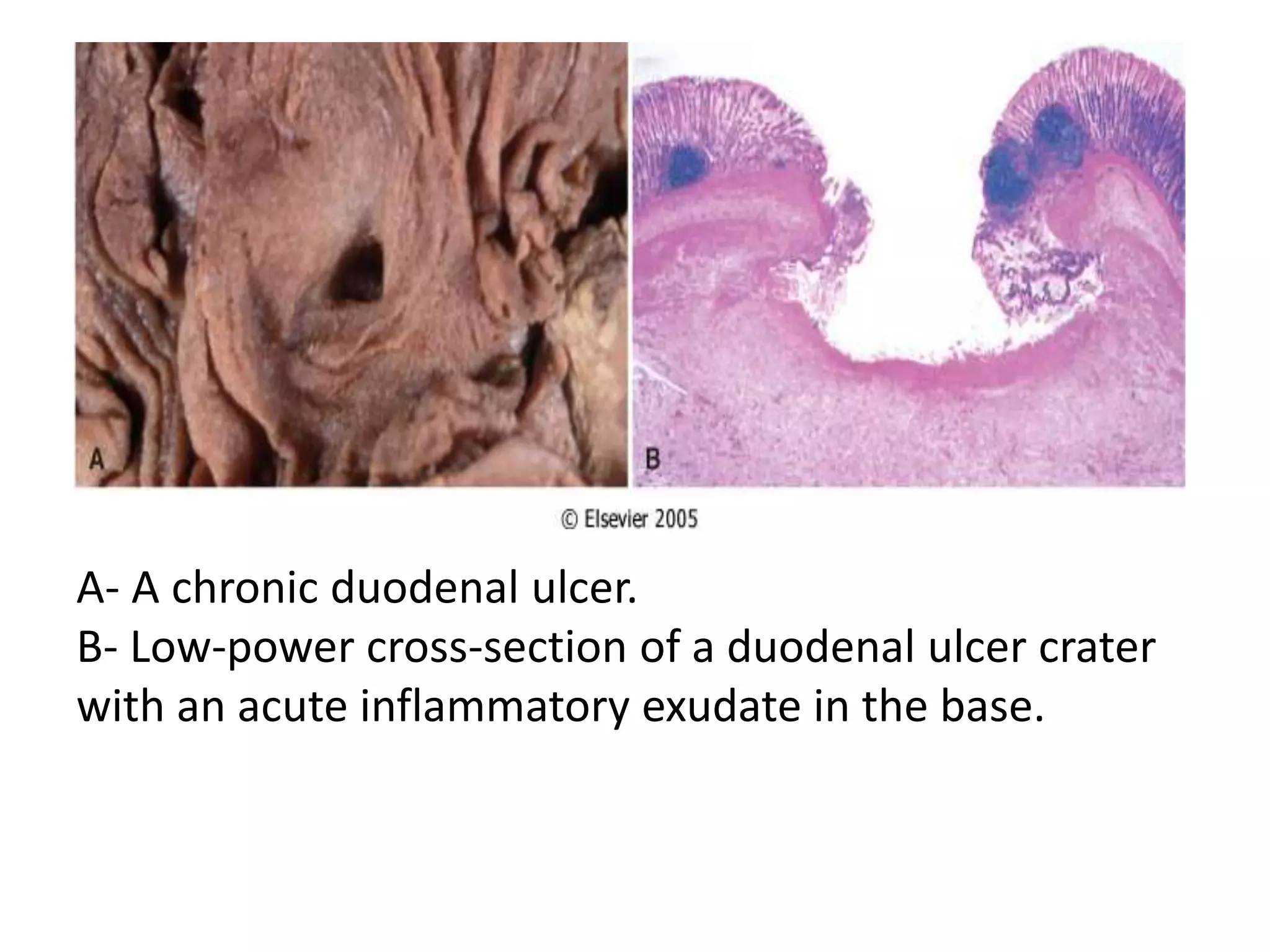 Acute inflammation | PPTX | Blood Disorders | Diseases and Conditions