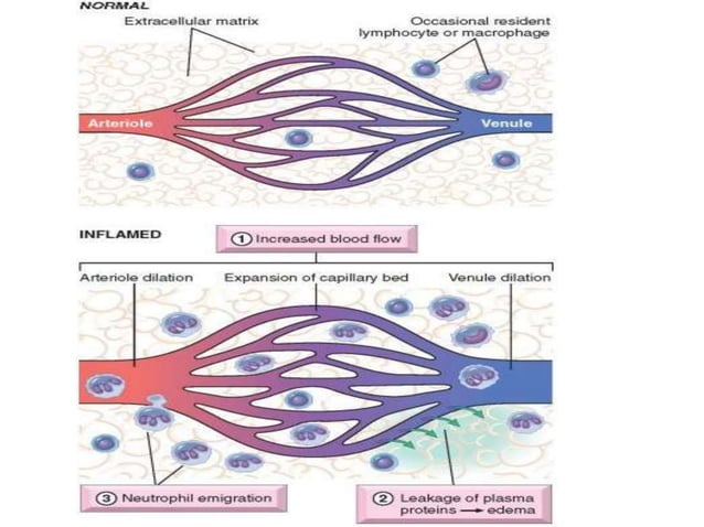 Acute inflammation | PPT