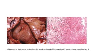 acute inflammation.pptx