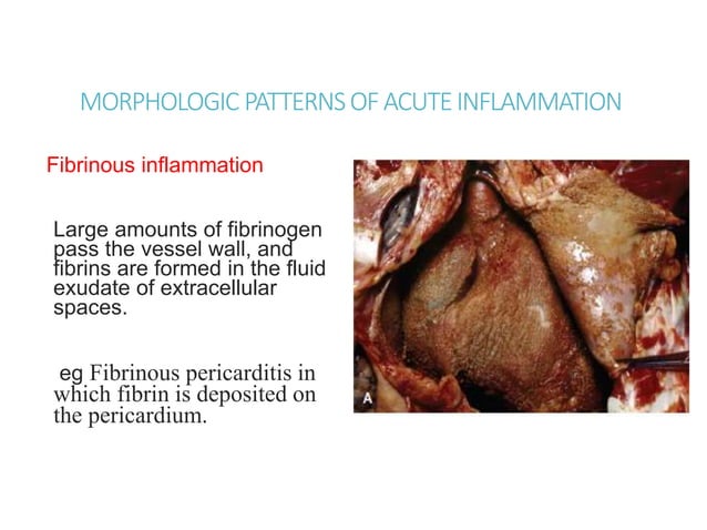 acuteinflammationacuteinflammation.pptxacuteinflammation.pptx