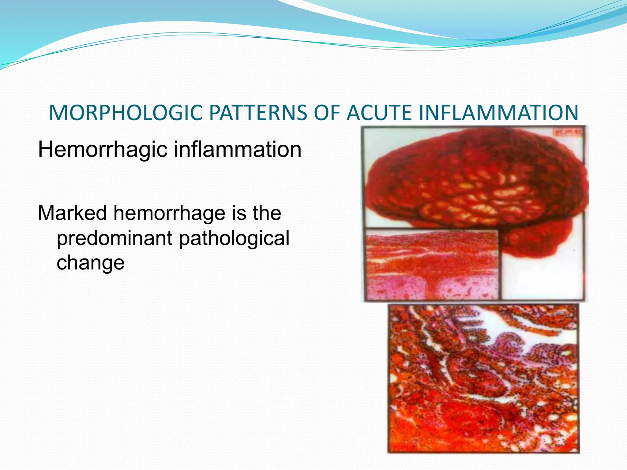 Acute Inflammation.pptx pathology 1 for medical students | PPTX