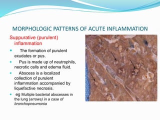 Acute Inflammation.pptx pathology 1 for medical students | PPTX