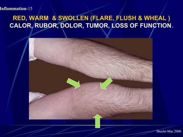 Pathology of Acute Inflammation | PPT | Blood Disorders | Diseases and ...