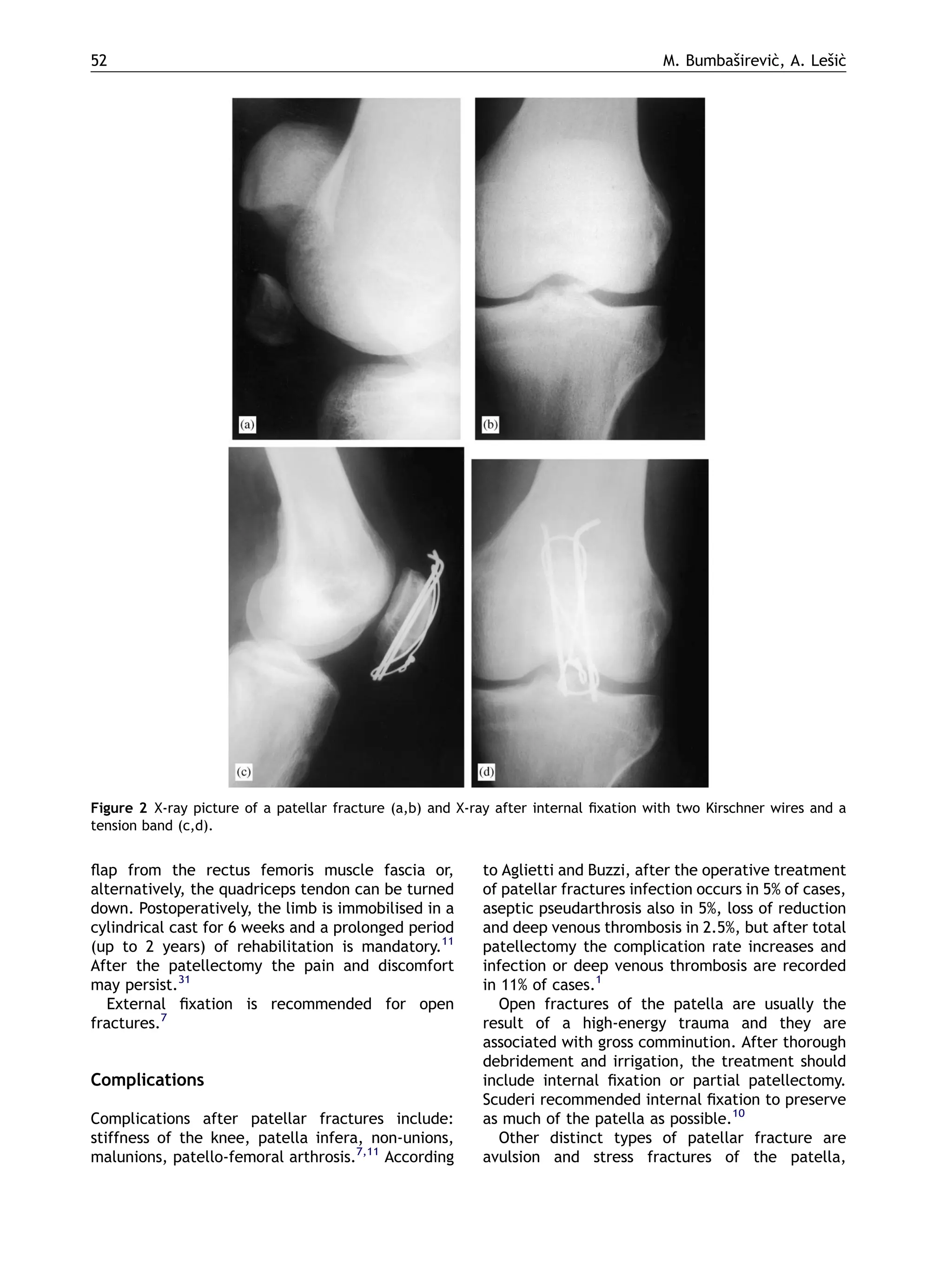Acute injuries of the extensor mechanism of the knee.pdf