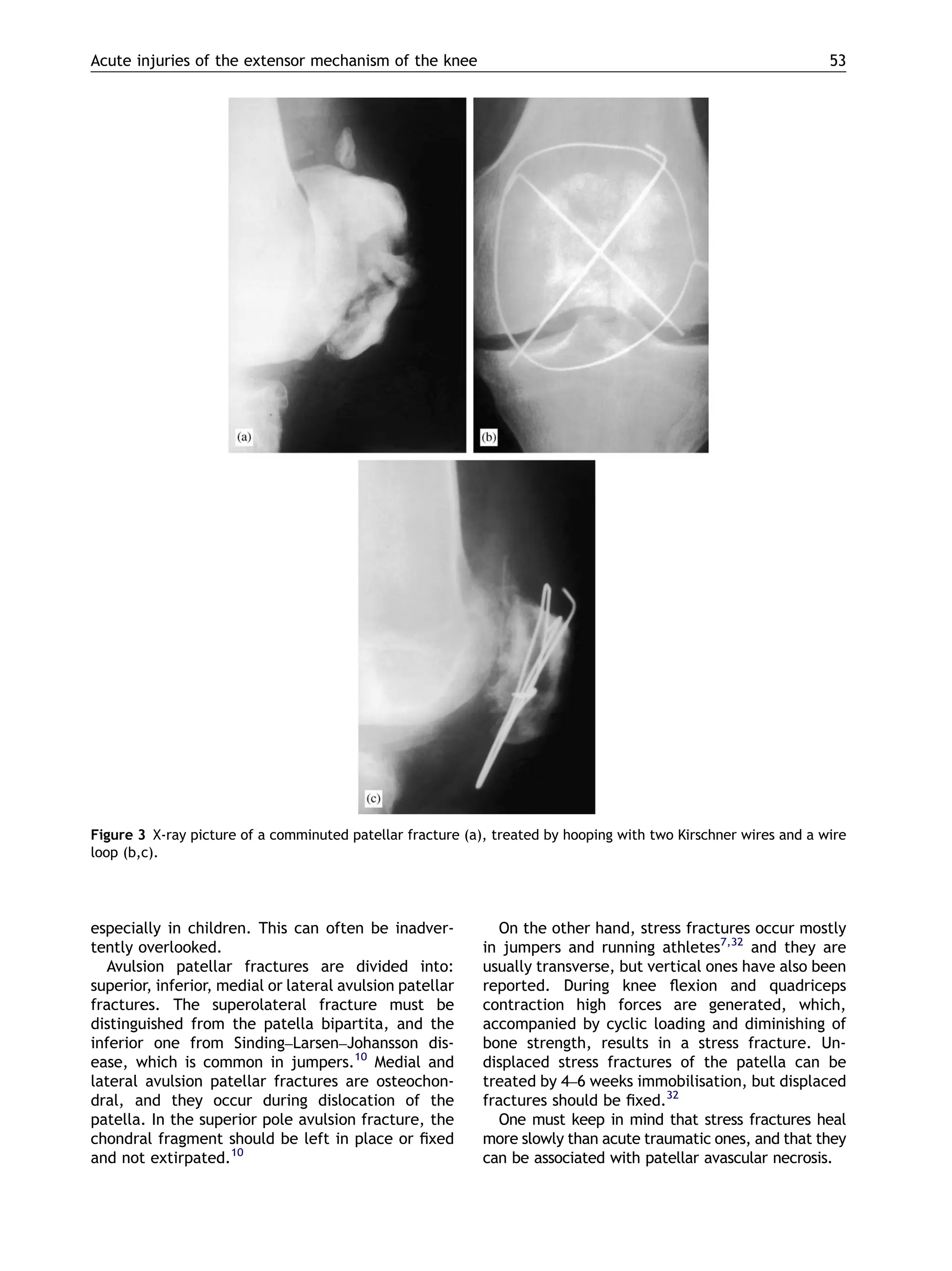Acute injuries of the extensor mechanism of the knee.pdf