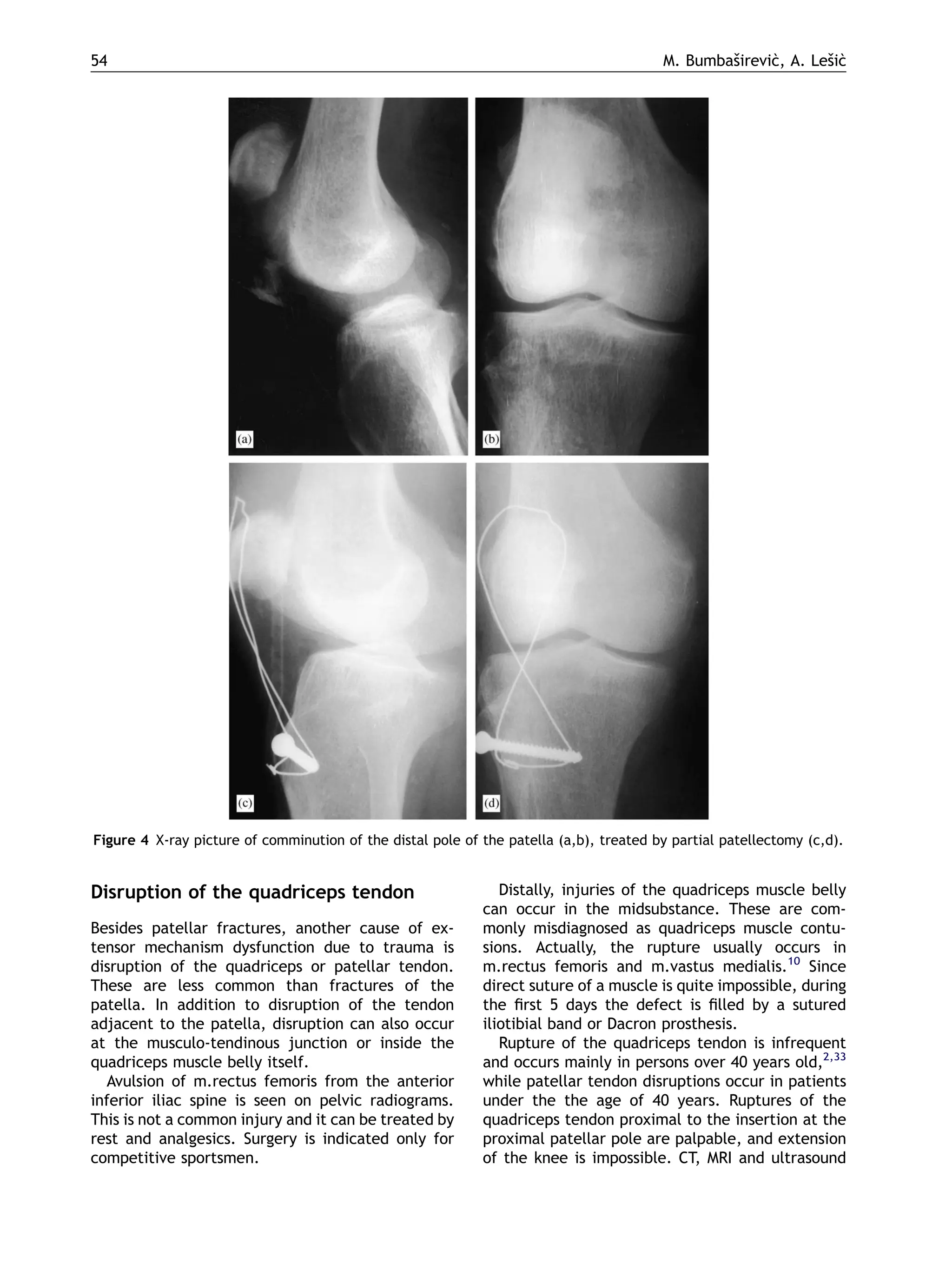 Acute injuries of the extensor mechanism of the knee.pdf