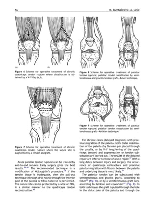 Acute injuries of the extensor mechanism of the knee.pdf