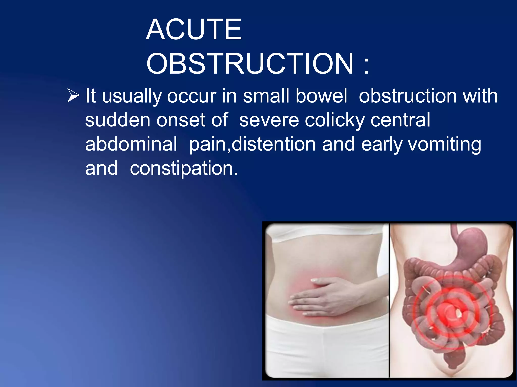 Acute intestinal obstruction | PPTX