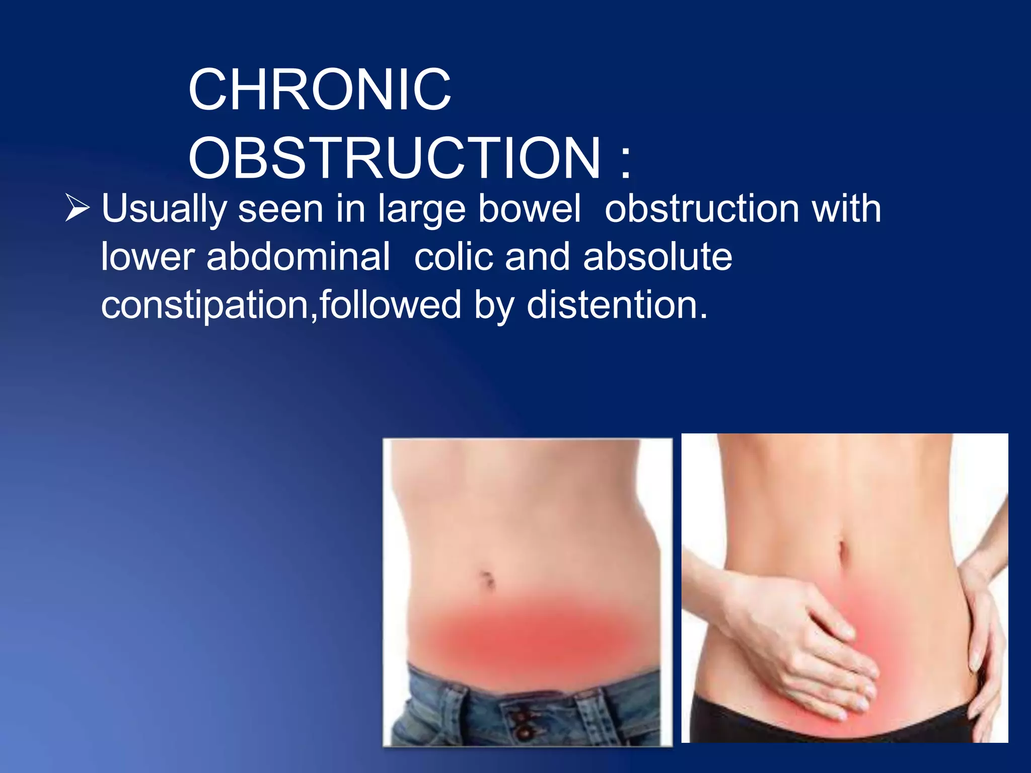 Acute intestinal obstruction | PPTX
