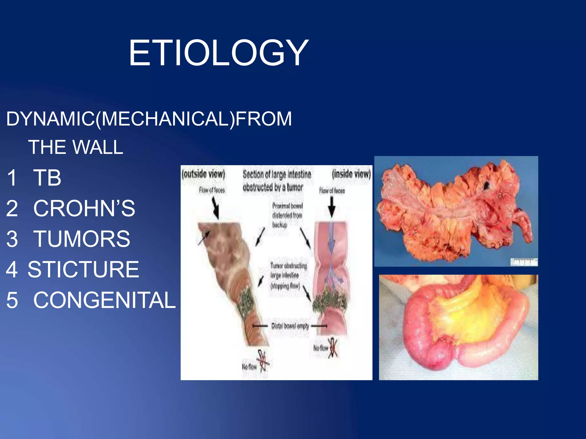 Acute intestinal obstruction | PPTX | Digestive Disorders | Diseases ...