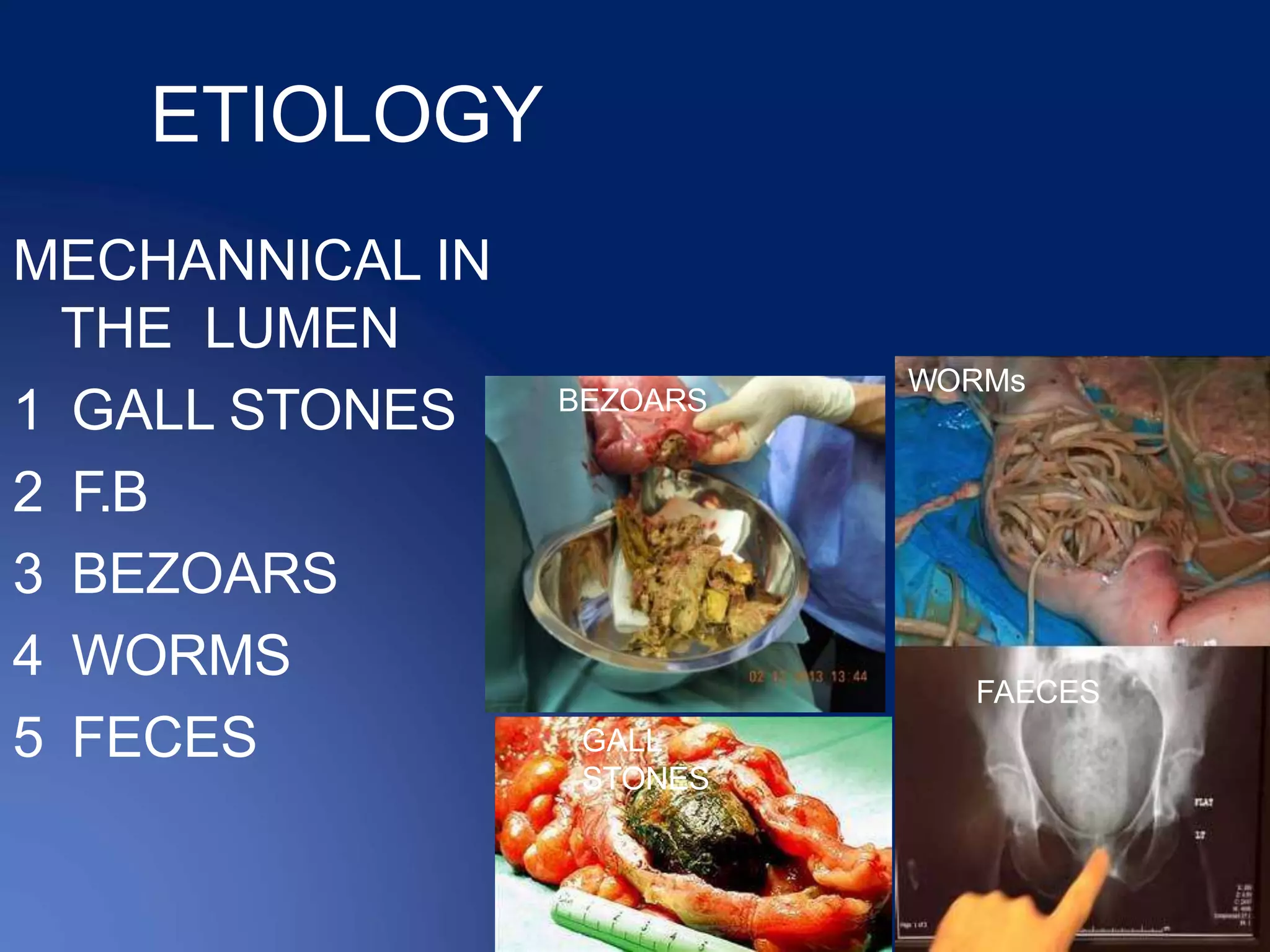 Acute intestinal obstruction | PPTX