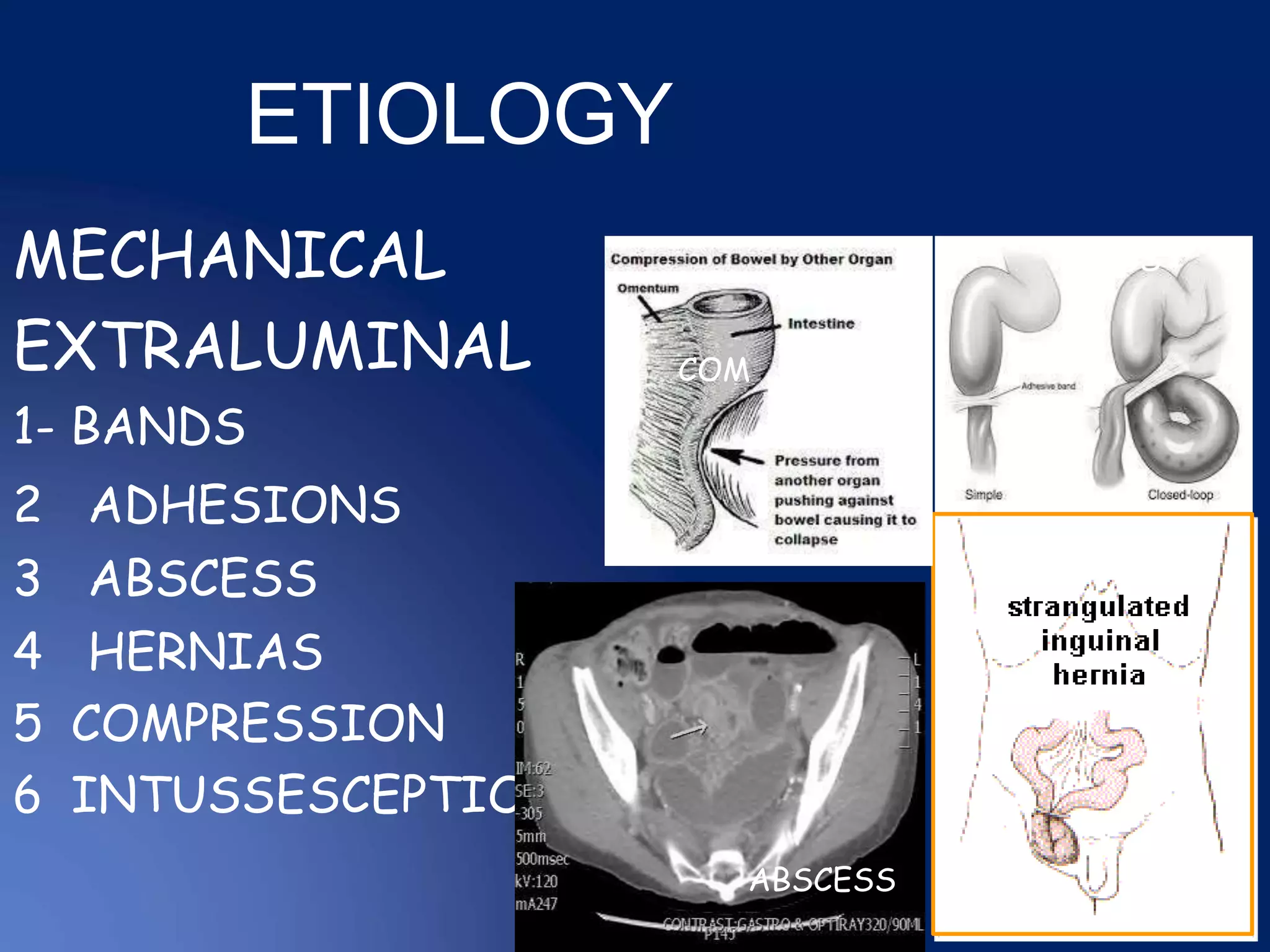 Acute intestinal obstruction | PPTX