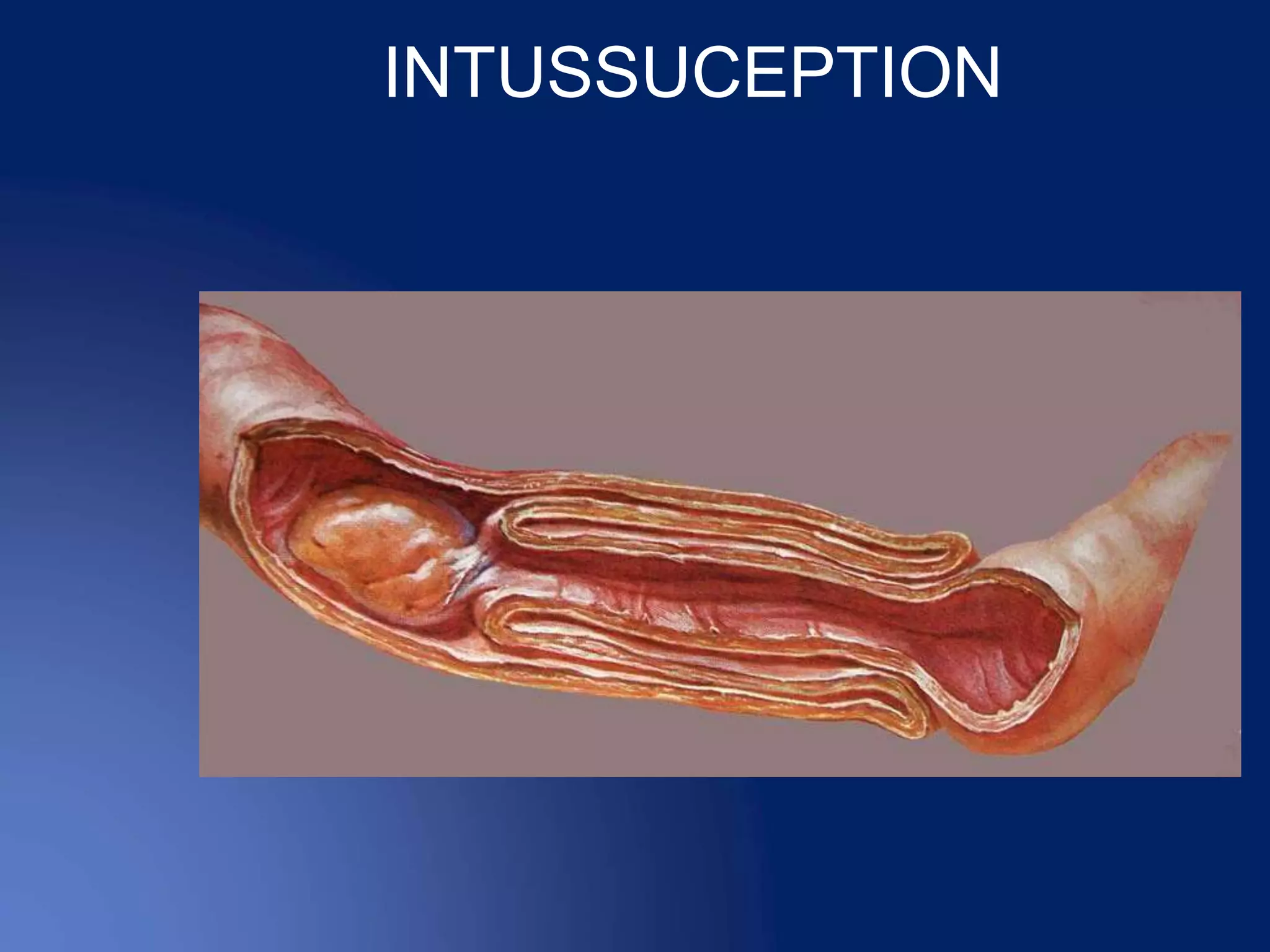 Acute intestinal obstruction | PPTX