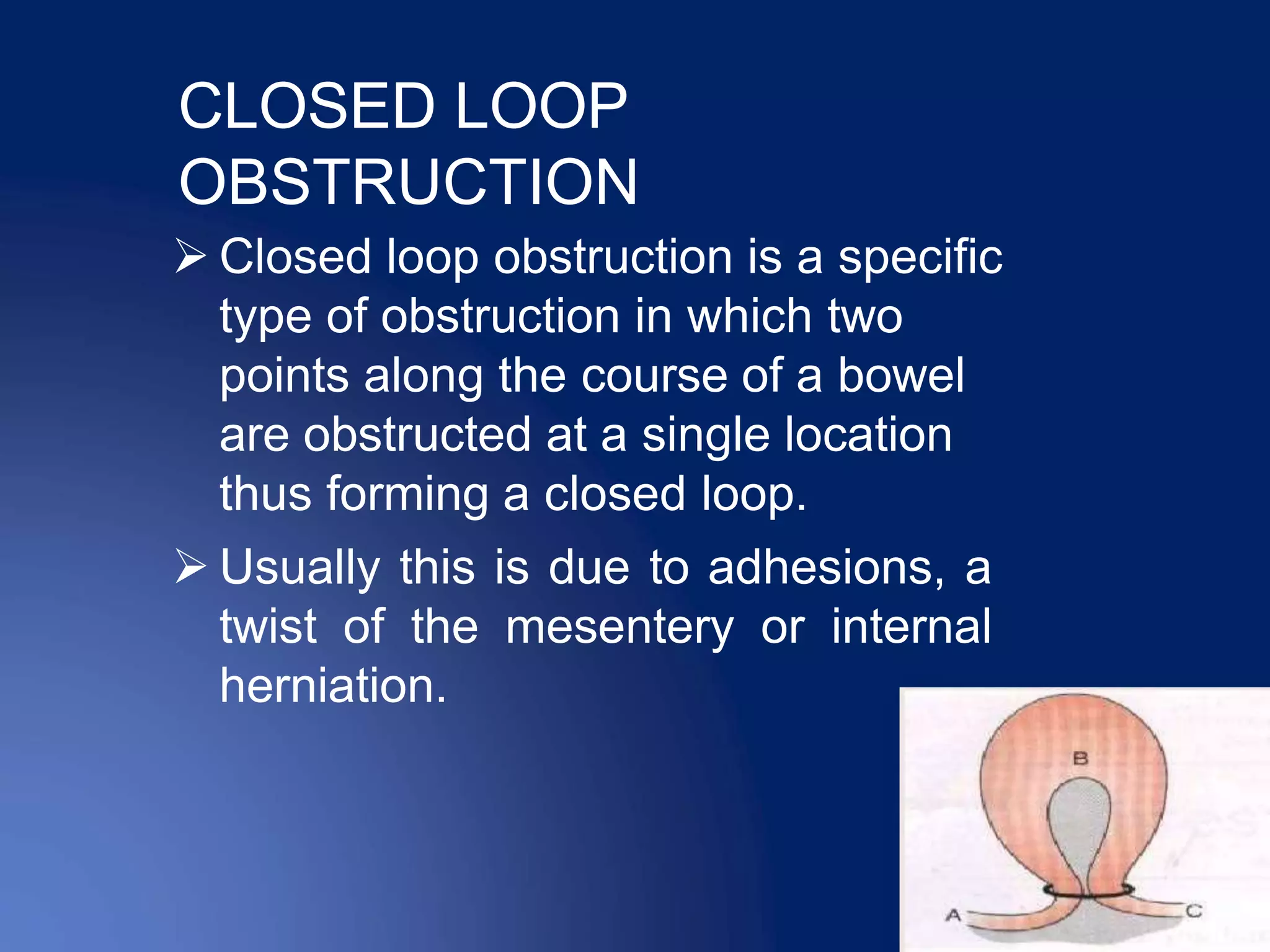 Acute intestinal obstruction | PPTX