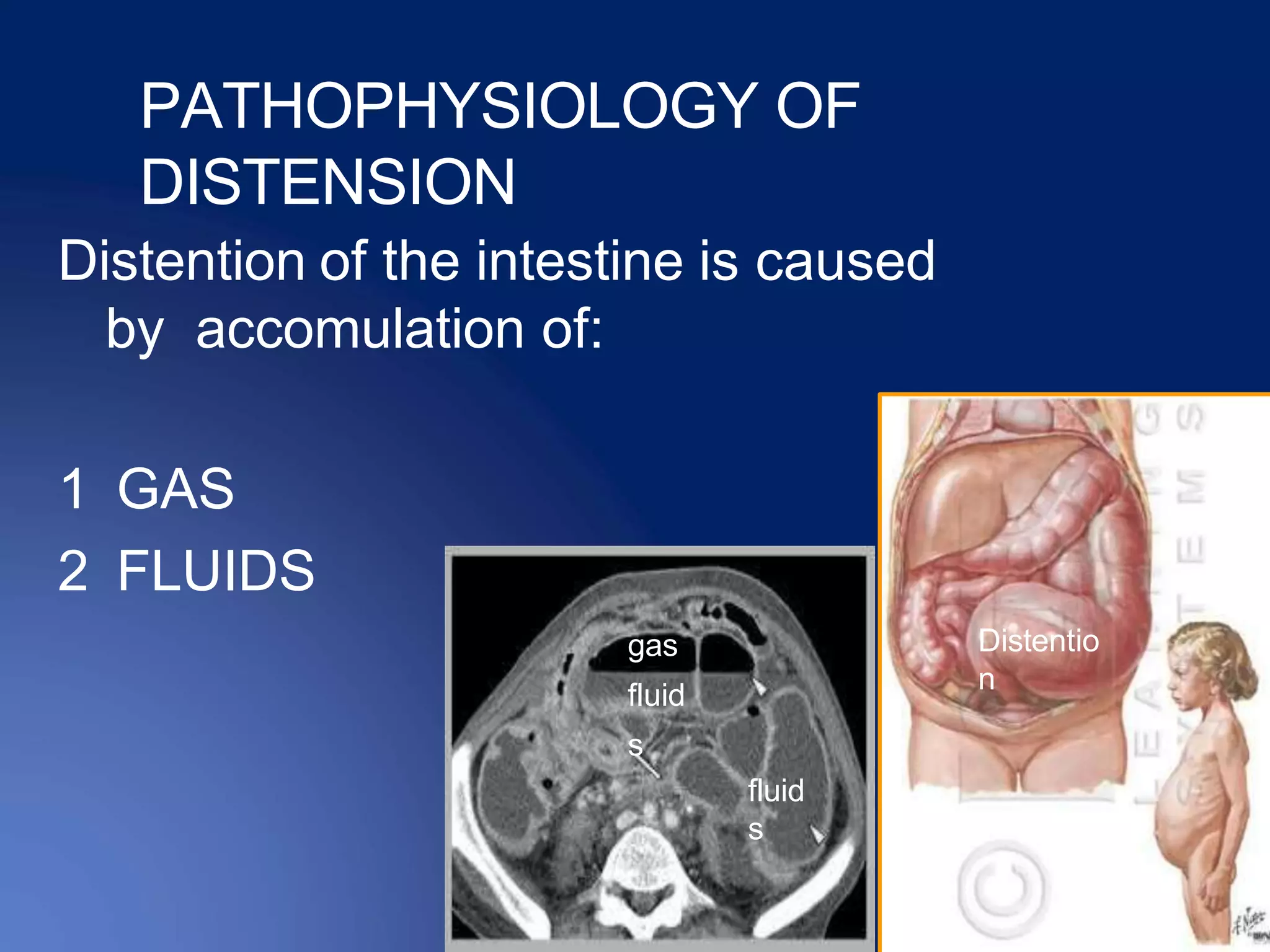 Acute intestinal obstruction | PPTX | Digestive Disorders | Diseases ...