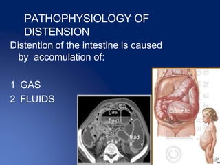 Acute intestinal obstruction | PPTX