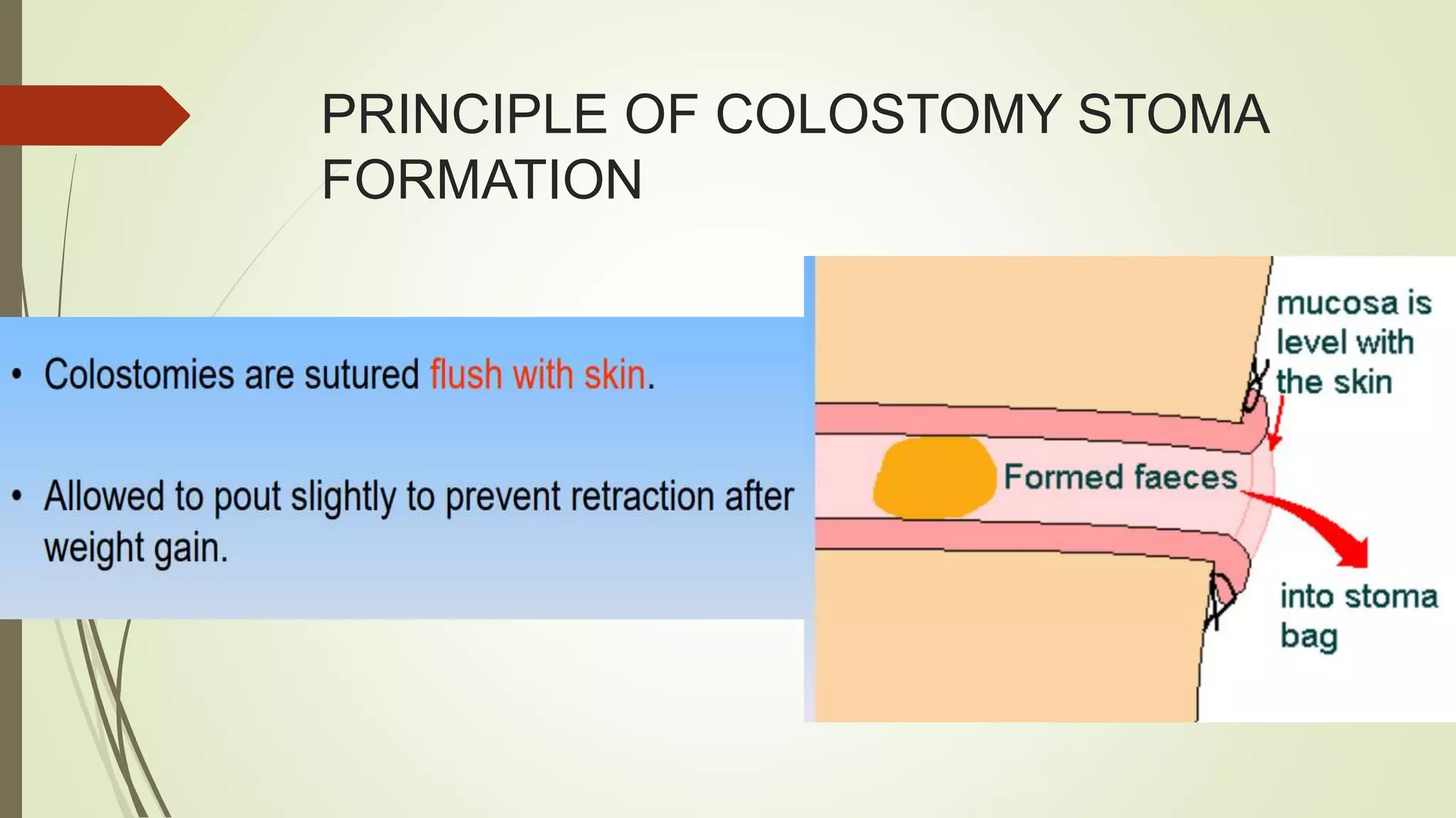 Intestinal Obstruction.pptx
