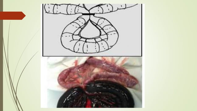 Intestinal Obstruction.pptx