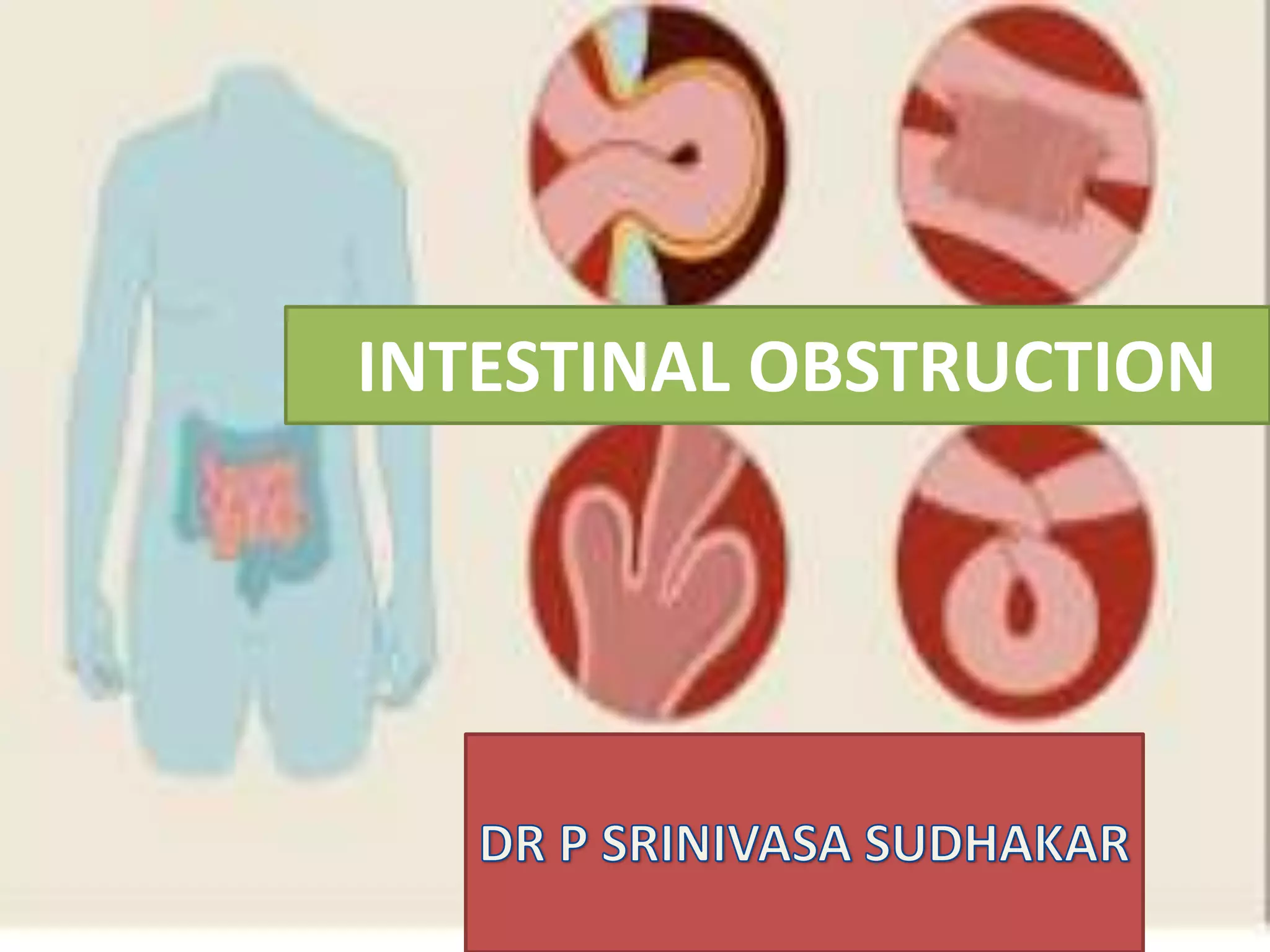 ACUTE INTESTINAL OBSTRUCTION.pptx