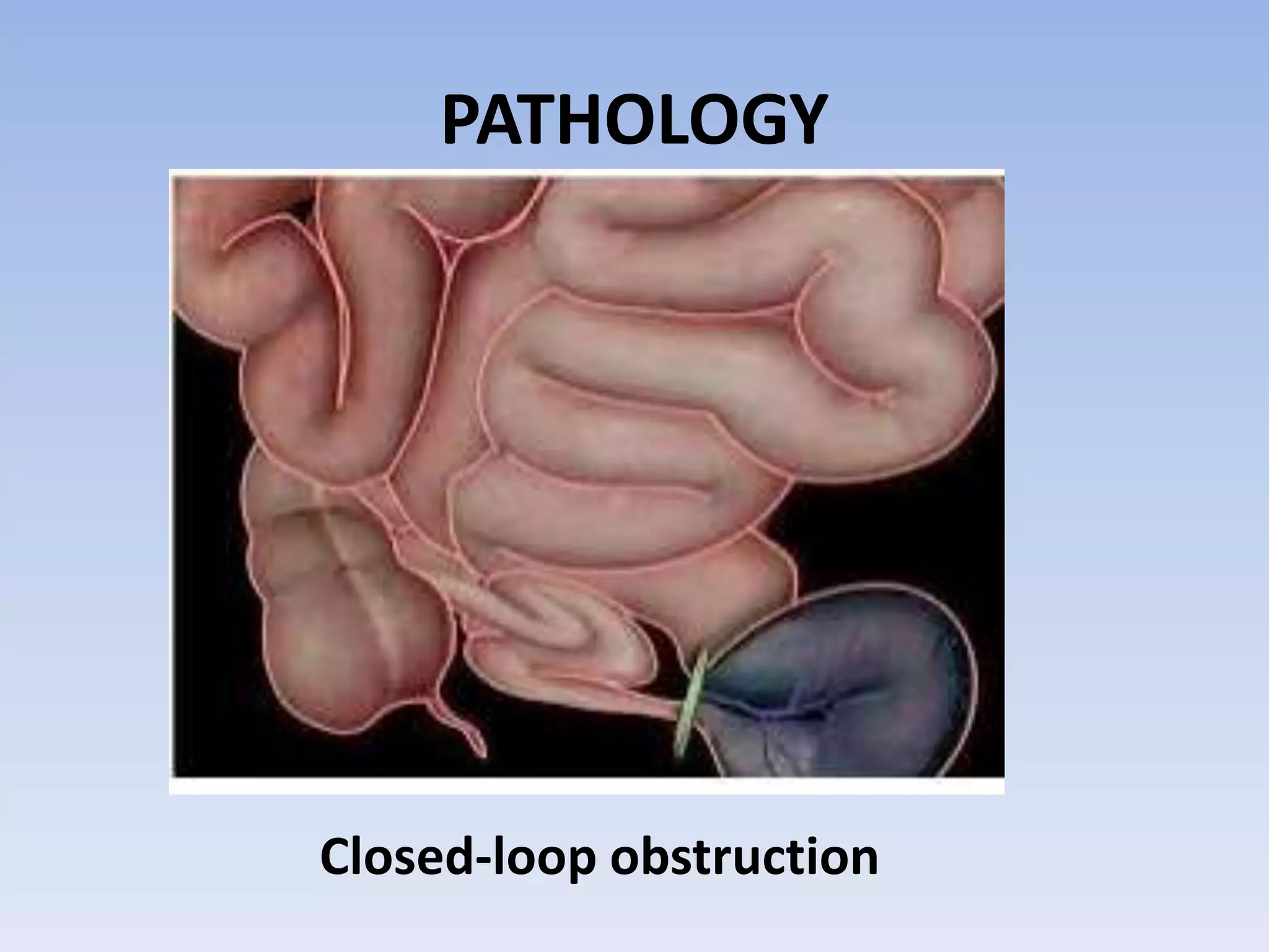 ACUTE INTESTINAL OBSTRUCTION.pptx